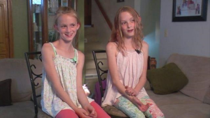 Conjoined twins Bella and Abby have been physically connected since birth